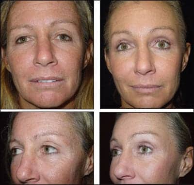 Notes From the Field: The Midface Lift - Plastic Surgery Practice