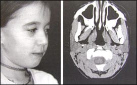 Adding Volume to the Cheeks Prolongs a Youthful-Looking Face - Plastic ...