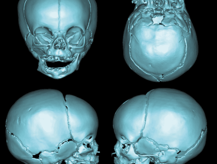 PRS Global Open Article Discussion: “Surgical Classification of the ...