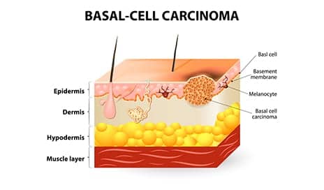 Update on Advanced Basal Cell Carcinoma Diagnosis and Treatment ...