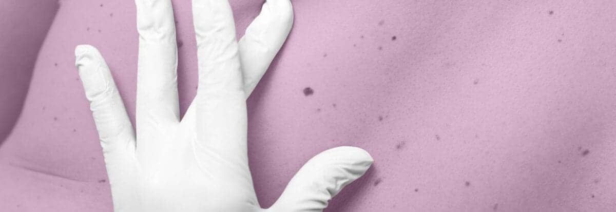 Could That Old Mole Be Skin Cancer? - Plastic Surgery Practice