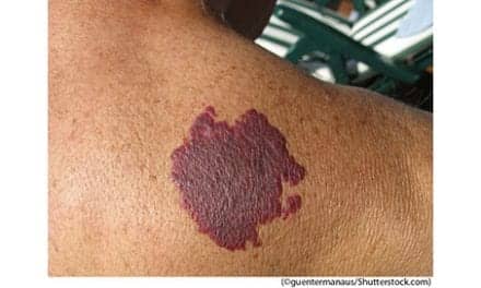 UV Exposure and Melanoma Risk in Patients With Skin of Color - Plastic ...